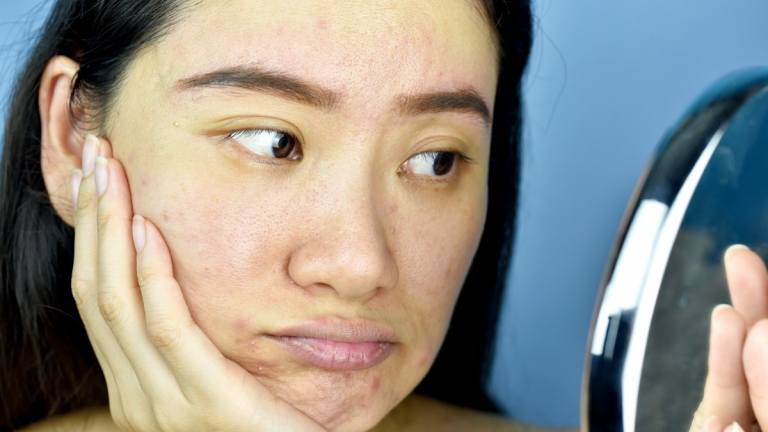 Inilah 4 Cara Memperbaiki Skin Barrier Rusak, Perbaiki Dari Sekarang ...